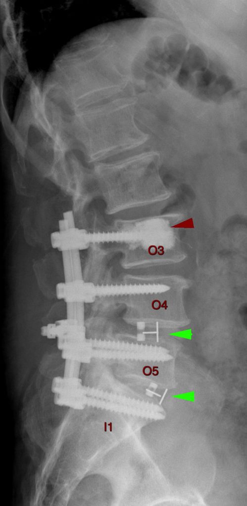 Κάταγμα Σπονδύλου: Συμπτώματα & Θεραπεία | Δρ. Σαμαράς